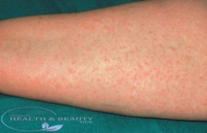 Skin Rash - Description of the elements of the Rash, Types and Treatment