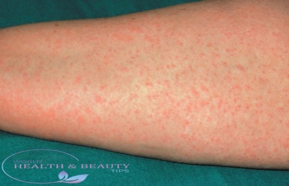 Skin Rash - Description of the elements of the Rash, Types and Treatment