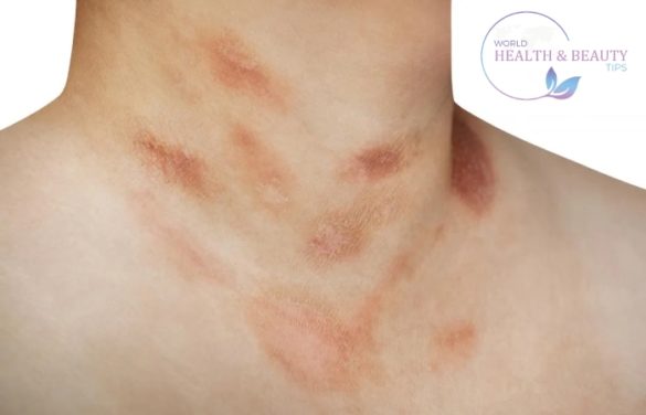 Skin Rash - Description of the elements of the Rash, Types and Treatment