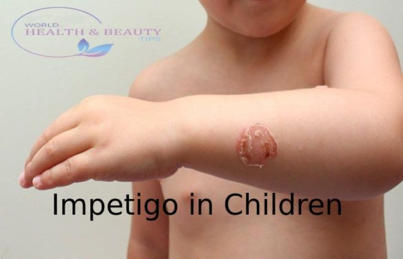 Impetigo in children - Causes, Symptoms, Diagnosis & Treatment