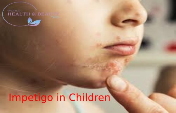 Impetigo in children - Causes, Symptoms, Diagnosis & Treatment