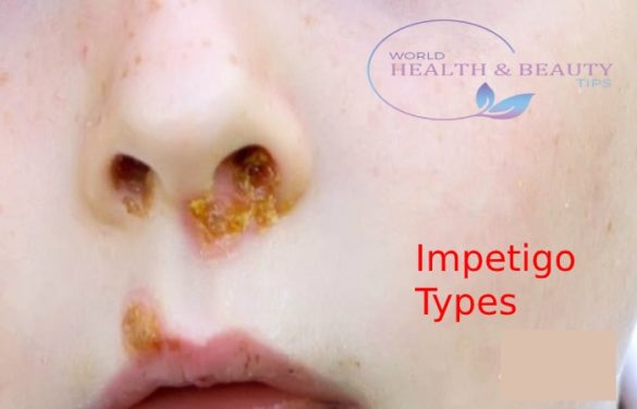Impetigo in children - Causes, Symptoms, Diagnosis & Treatment