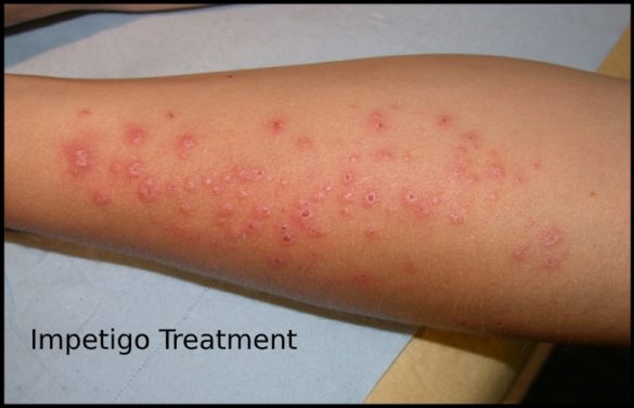 Impetigo in children - Causes, Symptoms, Diagnosis & Treatment